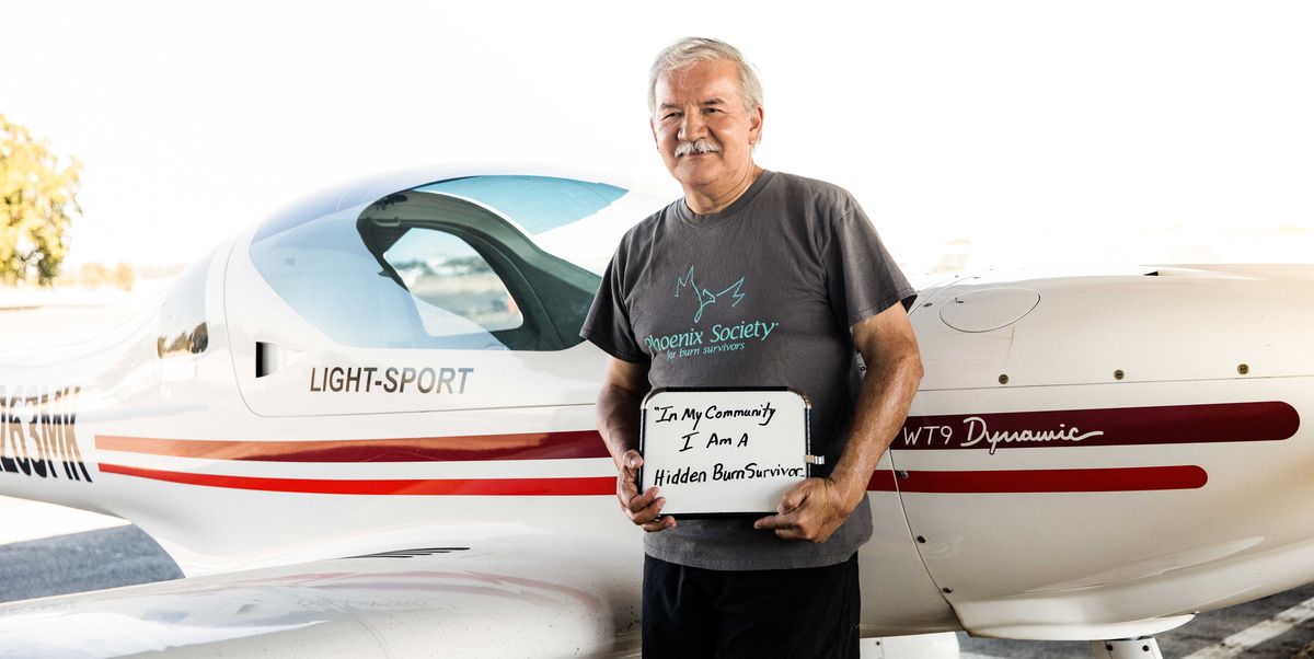 Plane Crash Survivor on Living With “Hidden” Burns - Xpert Fly Fisher